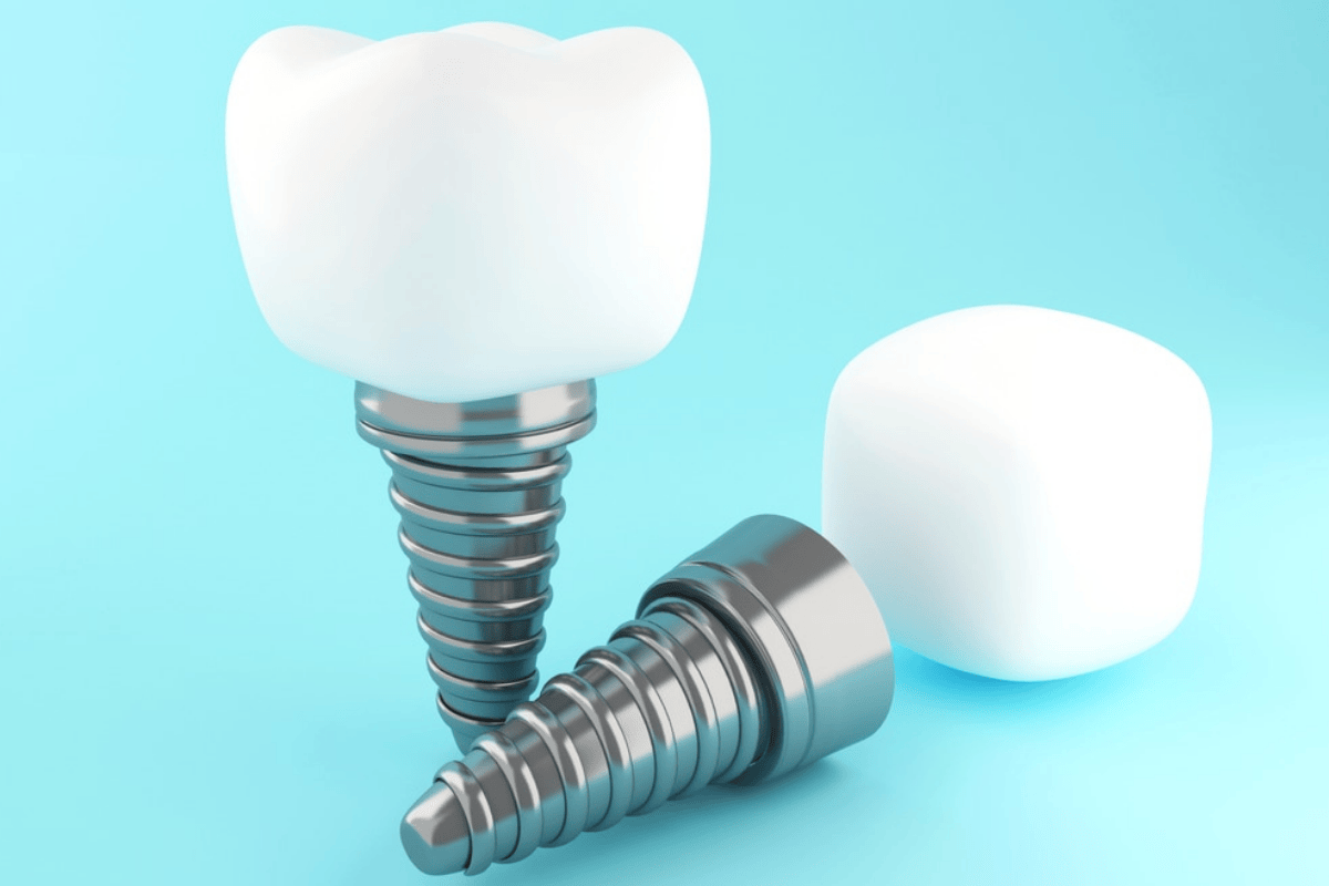 Mini Dental Implants: A Comprehensive Guide
